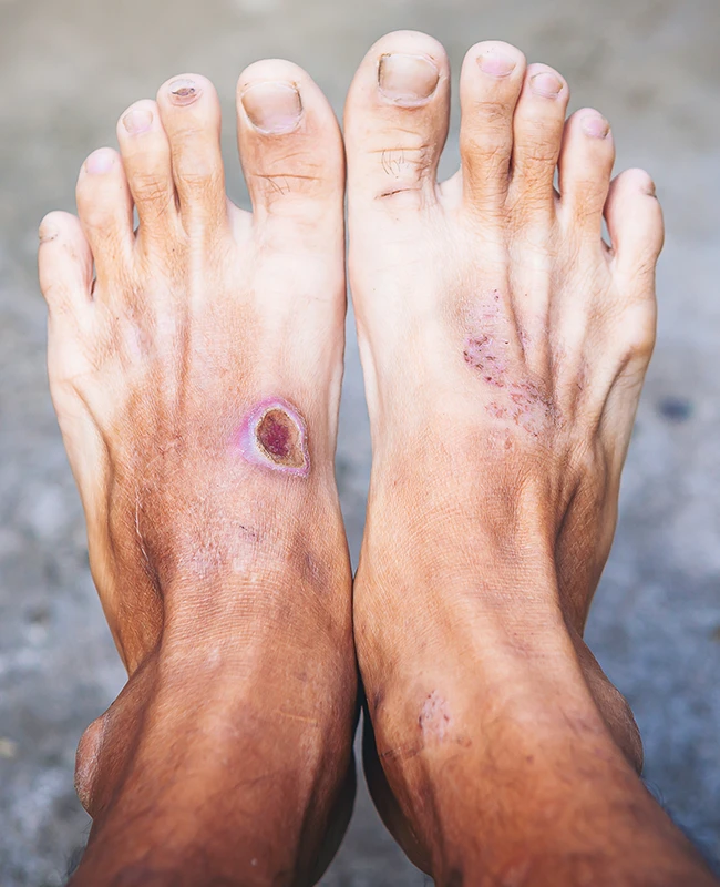 Diabetic foot - Perimed
